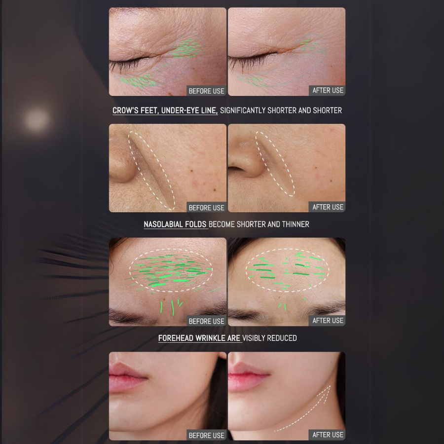 PRO Facial RF Skin Tightening Wand – Dr. Pen Australia