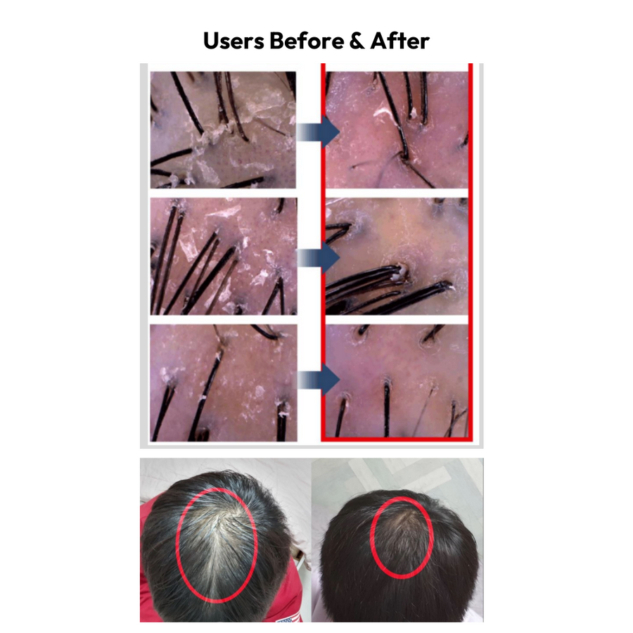 Rootonix Hair Growth Booster Scalp Care Device – Dr. Pen Australia